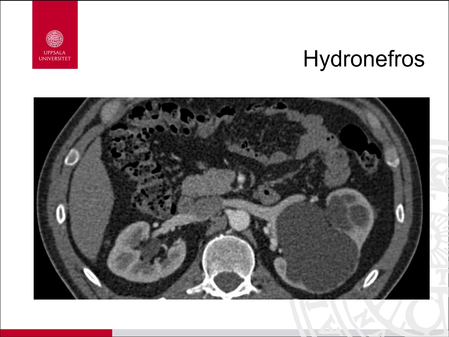 Akut Urologi del 1 njursten - Medfarm Play - Uppsala universitet