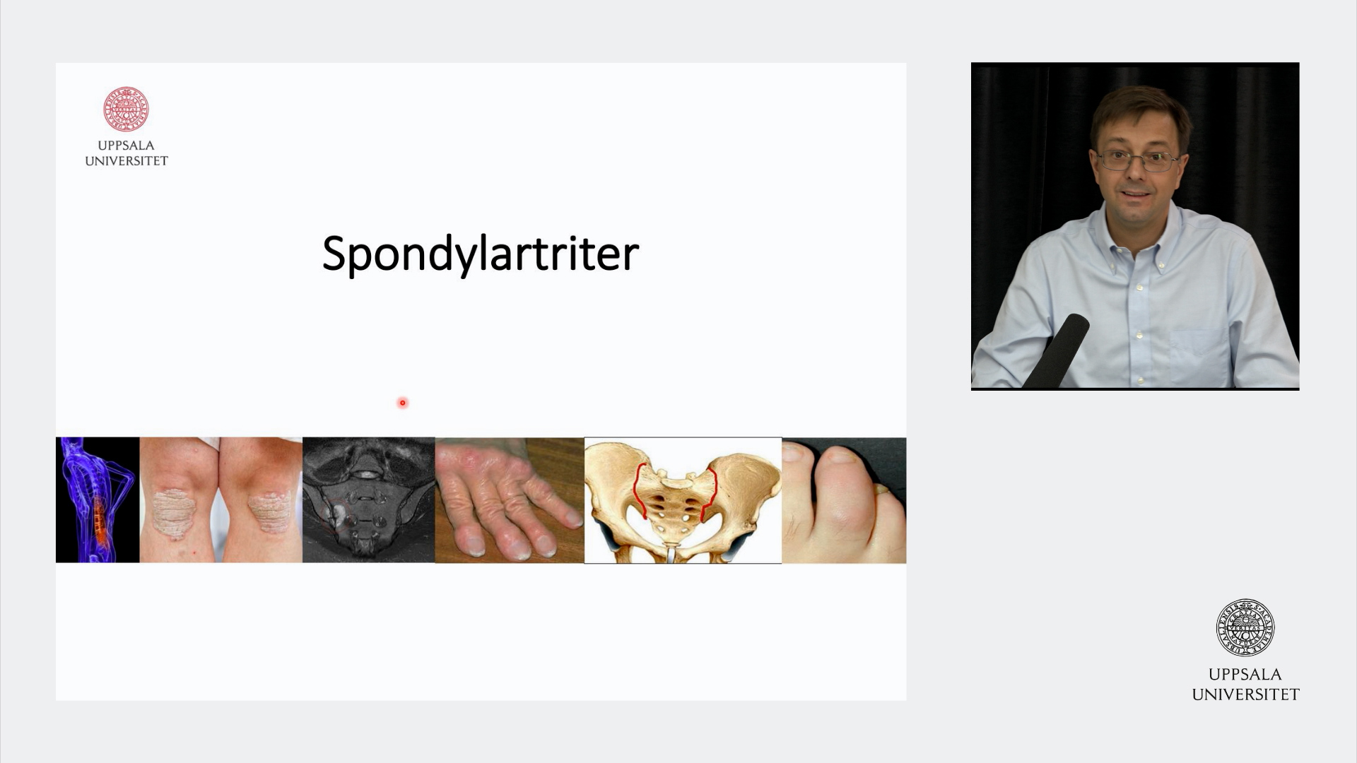 Spondylartriter - Medfarm Play - Uppsala universitet