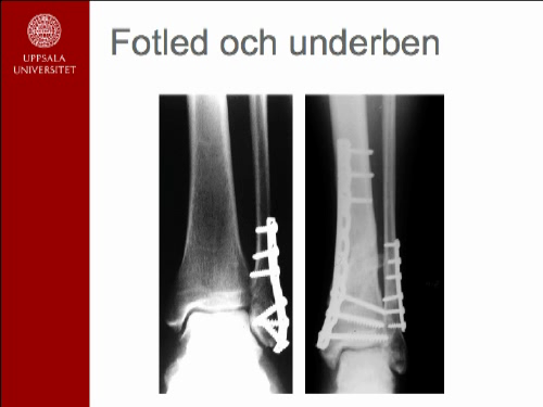 Ortopedisk omvårdnad Fotled... - Medfarm Play - Uppsala universitet